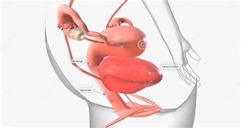 Gonorrhea Is A Sexually Transmitted Infection Caused By The Bacterium