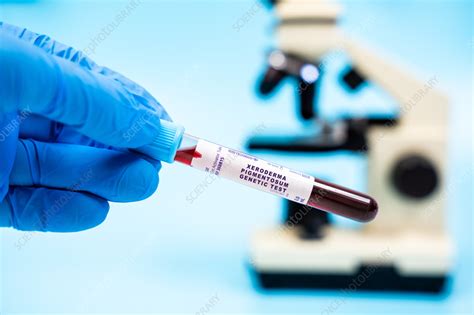 Xeroderma Pigmentosum Genetic Test Stock Image F0451771 Science Photo Library