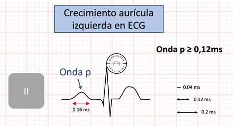 Flutter Auricular Ecg 2025
