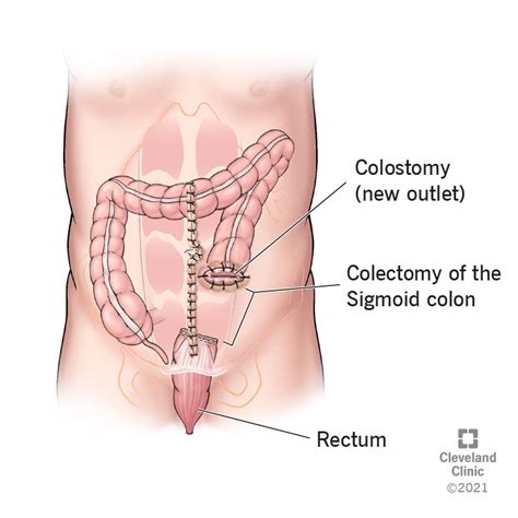 Loop Colostomy Reversal