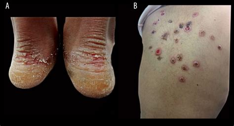 American Journal Of Case Reports Annular Epidermolytic Ichthyosis