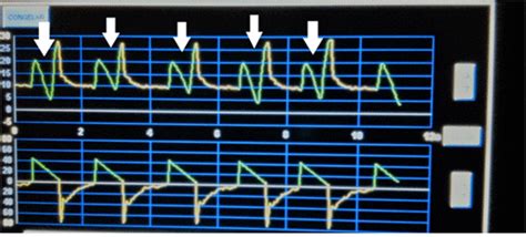 Identifying Patient Ventilator Asynchrony Using Waveform Analysis Identifying Patient Ventilator Asynchrony Using Waveform Analysis
