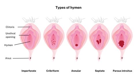 Hymenal Caruncle Normal