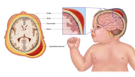 Head On Impact A Rare Case Of Cephalohematoma In Utero