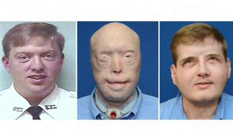 Whats It Like Living With A Face Transplant Bbc News