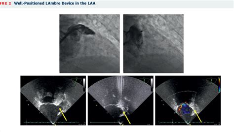 Figure 2 From Structural Atrial Intervention Focus Percutaneous Left