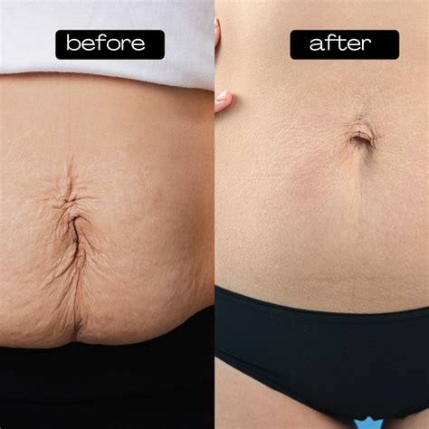 How To Tighten Loose Belly Skin Fast Loose Belly Skin Tightening