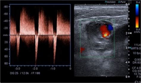 Pseudoaneurysms Different Ultrasound Patterns Aetiologies And Locations Pmc
