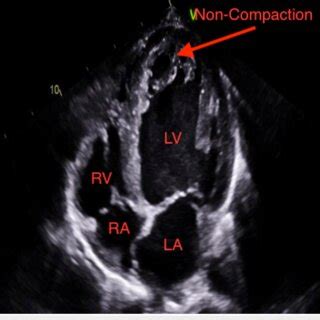 Apical 4 Chamber View Showing Lvnc Left Ventricular Non Compaction