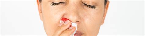 Epistaxis Nosebleed Mcgovern Medical School