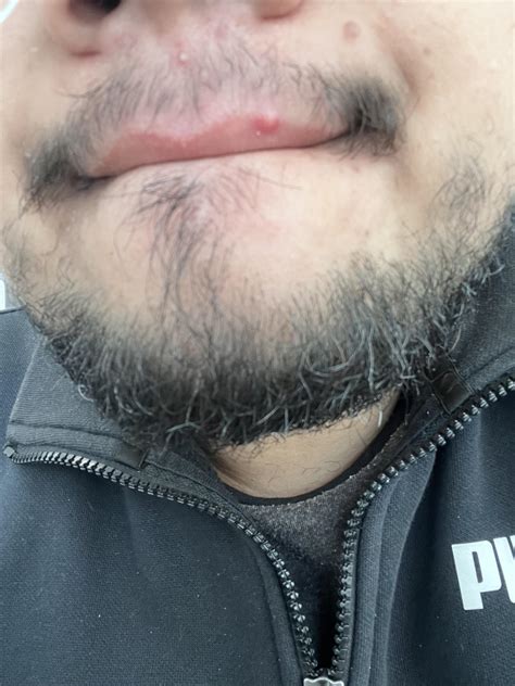 Bump On Upper Lip Rskin
