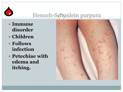 Ppt Bleeding Disorders Powerpoint Presentation Free Download Id