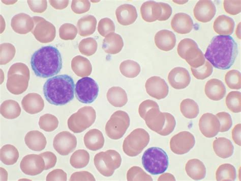 Leukemia Pathology Orthobullets