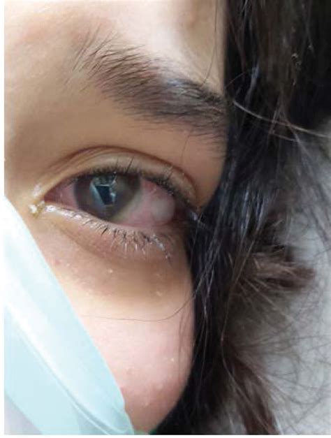 What Lies Behind An Hypopyon The Pediatric Infectious Disease Journal