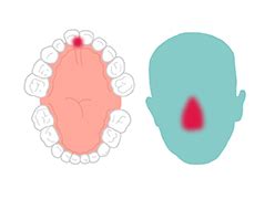 Noma A Neglected Disease