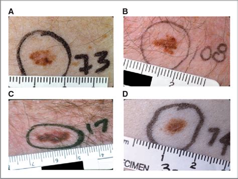 Dysplastic Nevus Vs Melanoma Pictures