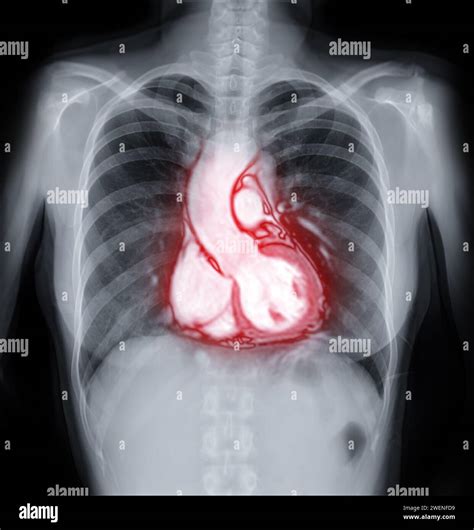 Mri Heart Or Cardiac Mri Magnetic Resonance Imaging Of Heart For