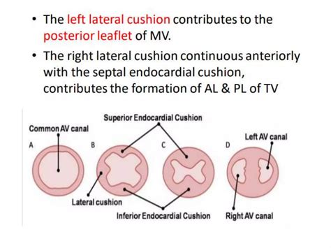 Atrioventricular Canal Defect Pptx Heart And Cardiovascular Diseases Diseases And Conditions