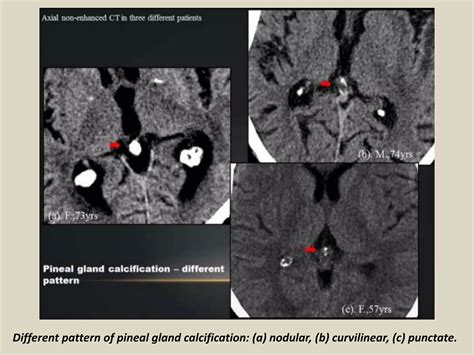 Presentation1pptx Radiological Imaging Of Intra Cranial Calcification