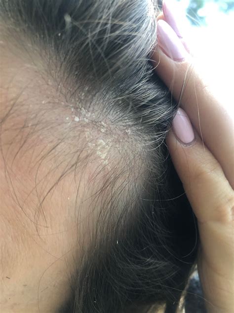 What Is This Sebboric Dermatitis Psoriasis Rskin