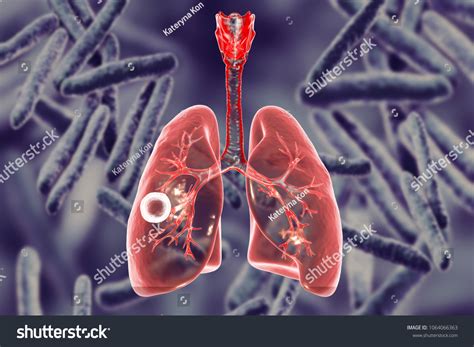 Fibrous Cavernous Pulmonary Tuberculosis 3d Illustration Showing Stock Illustration 1064066363