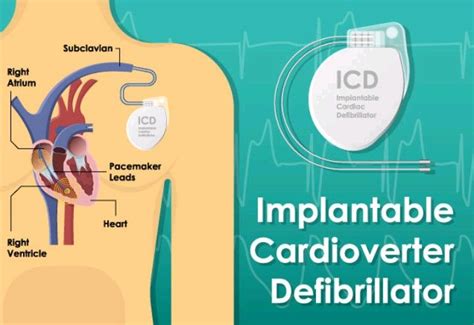 Seyed Mehdi Mousavi On Linkedin البته تکنولوژی باتری این دیوایس جدید بوده و مشابه Evera میباشد