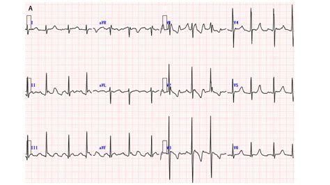 Intra Atrial Re Entrant Tachycardia After Percutaneous Atrial Septal Defect Closure A Case