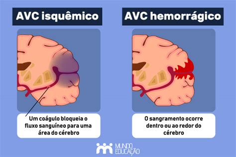 Acidente Vascular Cerebral Avc O Que é Como Identificar