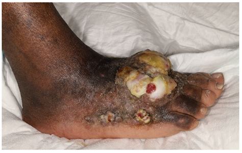Kaposis Sarcoma