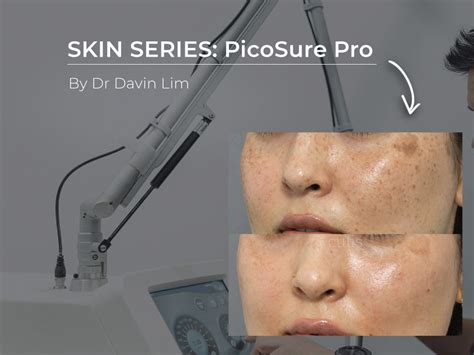Best Pico Laser Packages Brisbane Cutis Dermatology