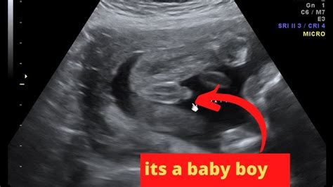 25 Weeks Fetus Ultrasound