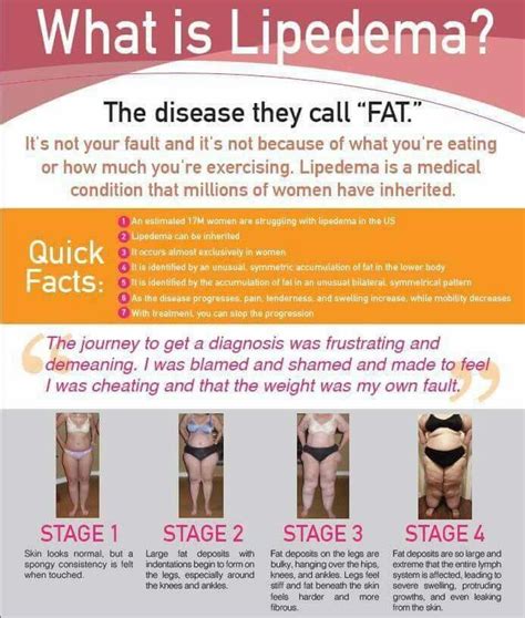 What Does Lipodema Mean Causes Symptoms And Treatment Of Lipoedema