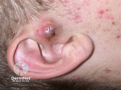 Conditions Affecting The Ear Images