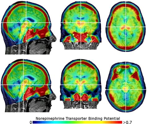 Parametric Voxel Wise Binding Potential Bpnd Maps Of The