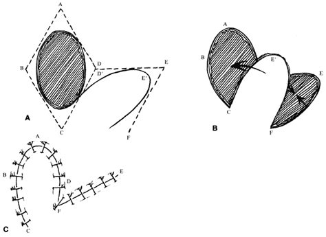 Rotation Flap Bilobed Flaps Cut Treatment Allows Modified Management Sketch Coloring Page
