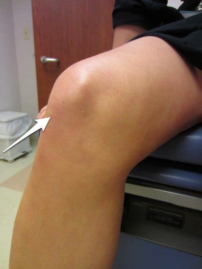Return To Sports After A Patellar Tendon Tear Dr Geier