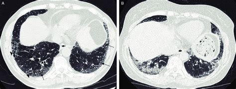 The Chest High Resolution Computed Tomography Characteristics Of Uip