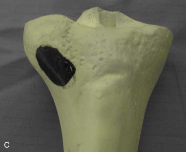 Tibial Bone Graft Pocket Dentistry