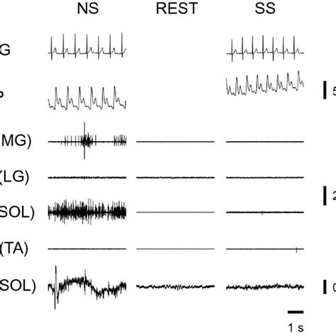 Typical Examples Of Waveforms Of Electrocardiography Ecg Bp Download Scientific Diagram