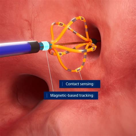 Farawave™ Nav Pfa Catheter Farapulse™ Pfa Platform