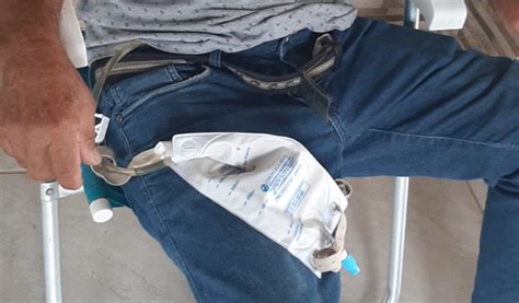 Em Prol Da Cirurgia Rtu De Próstata Com Patologia De Cid N40 Em Uso De Sonda Vesical Com