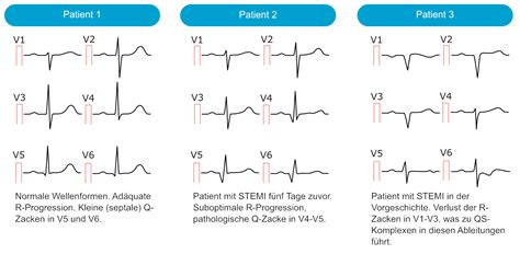 Ekg Interpretation Merkmale Des Normalen Ekgs P Welle Qrs Komplex