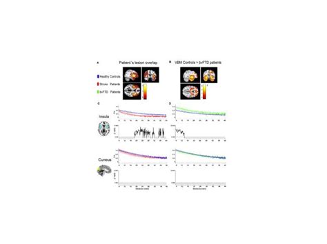 Stroke And Neurodegeneration Induce Different Connectivity Aberrations