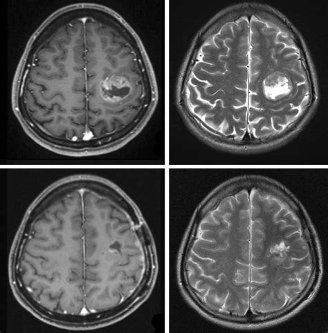 Magnetic Resonance Imaging Mri Before Initial Operation Showing The Download Scientific