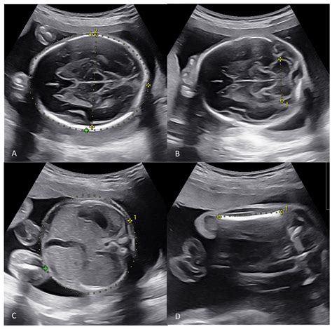 Determination Of Efficiency Of Transcerebellar Diameterabdominal