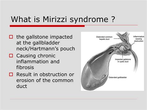 Ppt Mirizzi Syndrome An Uncommon Gallstone Complication Powerpoint