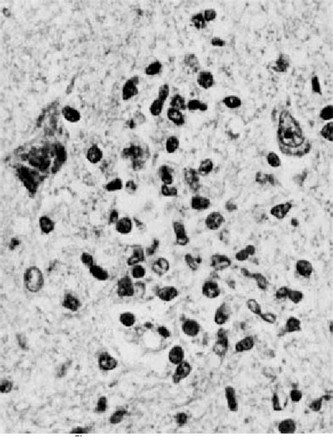 Figure 3 From Acute Inclusion Encephalitis Of Herpes Simplex Type