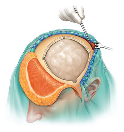What Is Stealth Guided Craniotomy At Amy Hartzell Blog