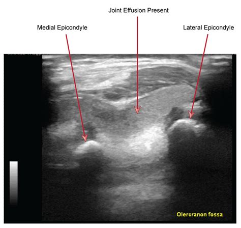 Joint Effusion Archives Pocus Journal