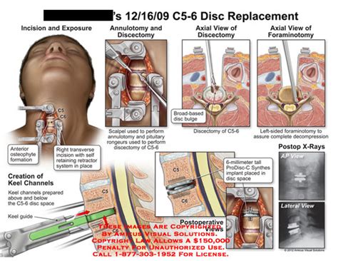 Amicus Illustration Of Amicus Surgery Cervical Spine Disc Replacement Osteophyte Formation Self